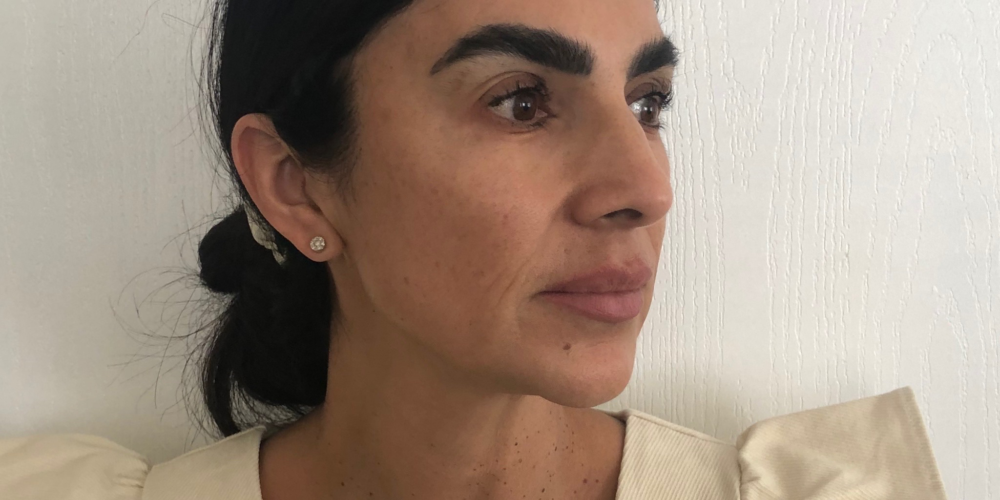 Thread Lift Before & After, Case 2 | Female | Align Medical Aesthetics ...